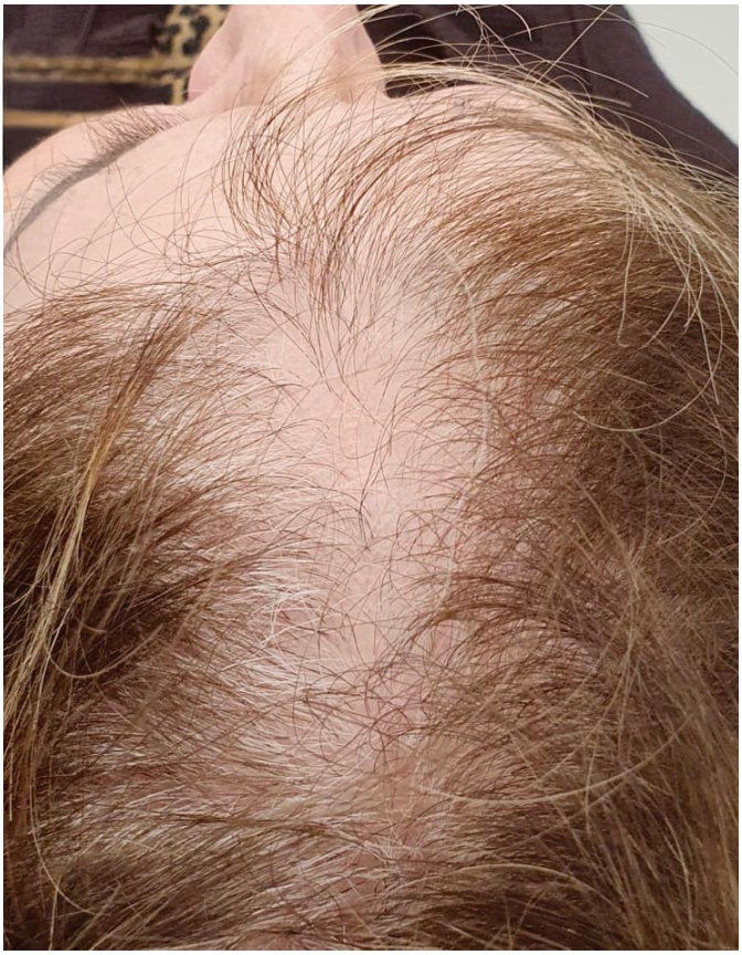 Tricopat® | Insparya Global